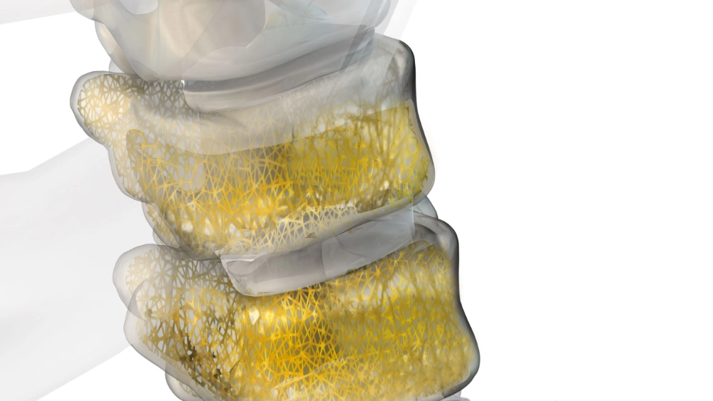 OSTEOPAL – Bone Cements for Spinal Surgery