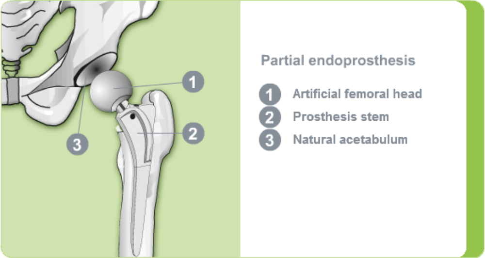 Artificial Hip Joint