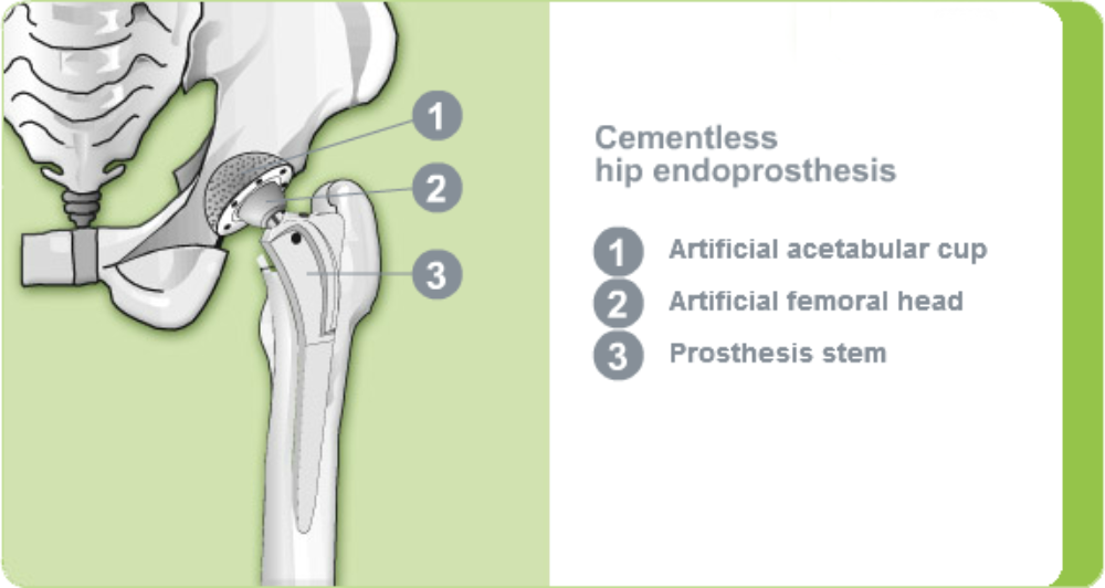 Fixation Hip Joint